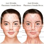 Printable Botox Injection Face Map - Template Free Printable