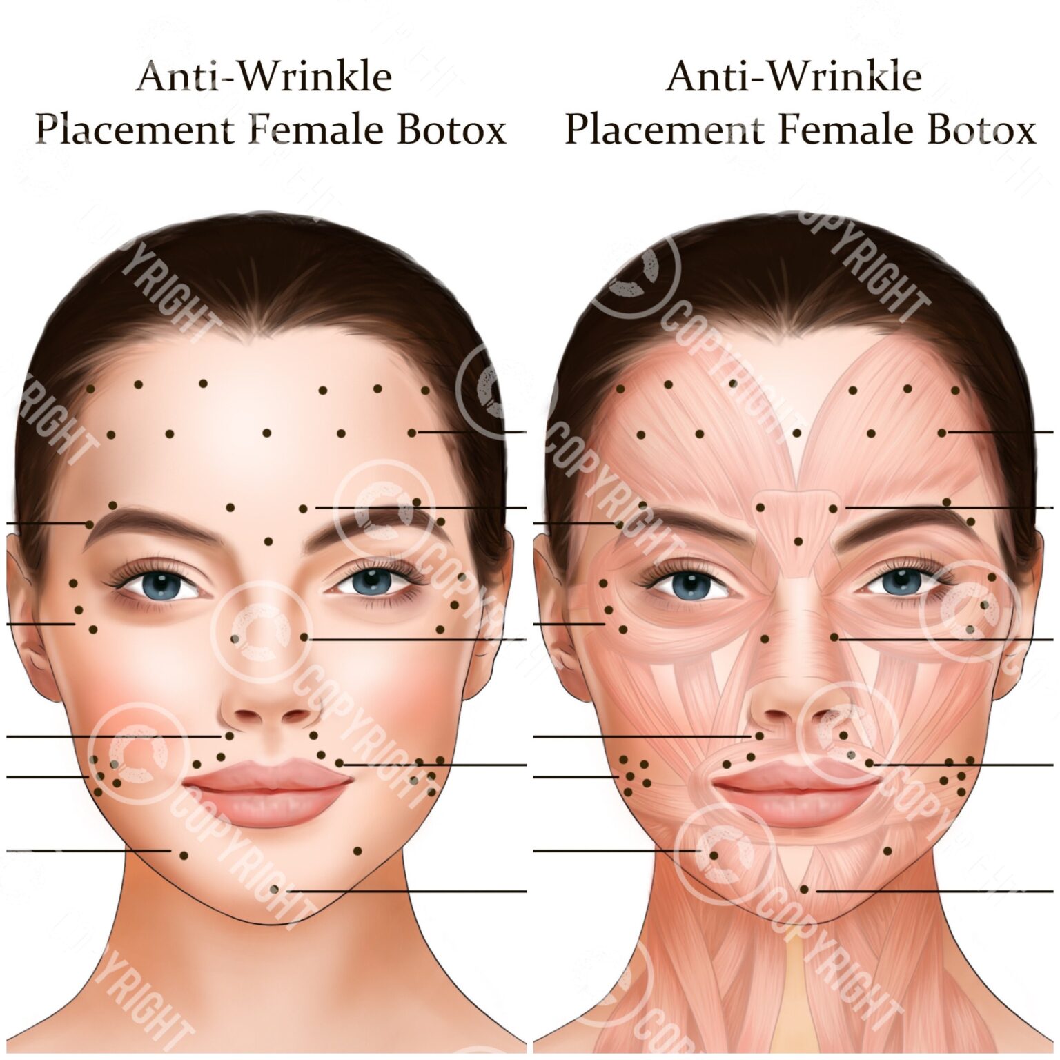 Printable Botox Injection Face Map - Template Free Printable