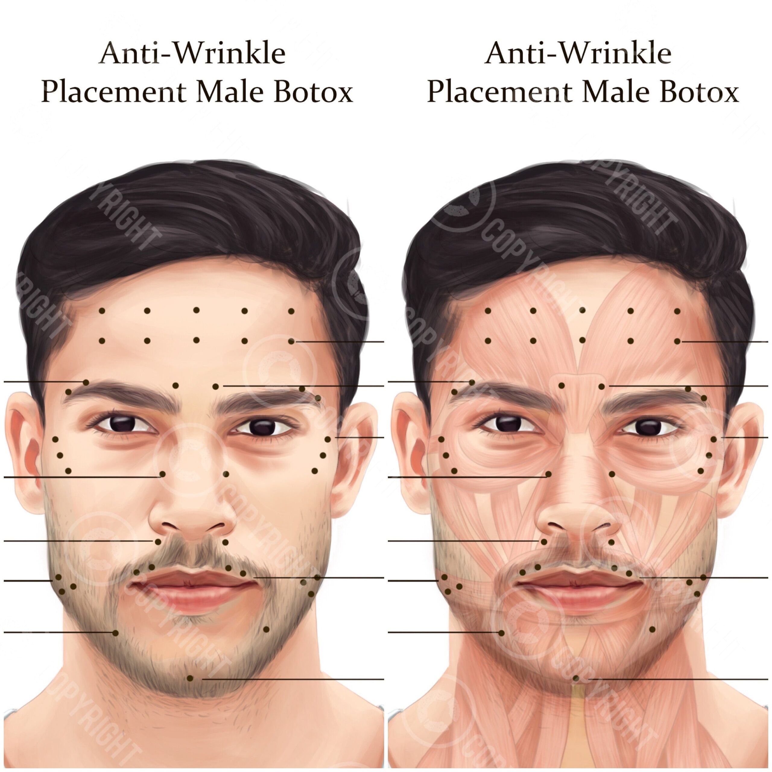 Printable Botox Injection Face Map - Template Free Printable